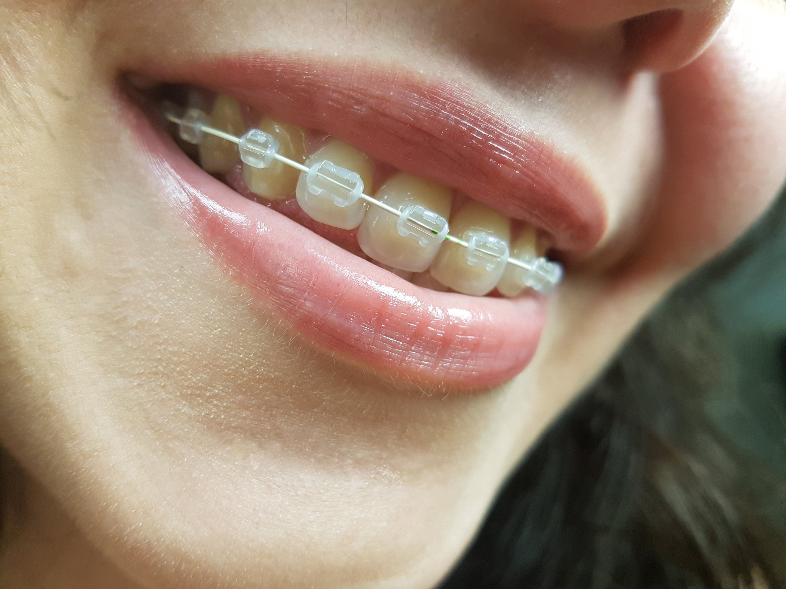Two Phase Treatment Matteson Orthodontics Two Phase Treatment Matteson Orthodontics