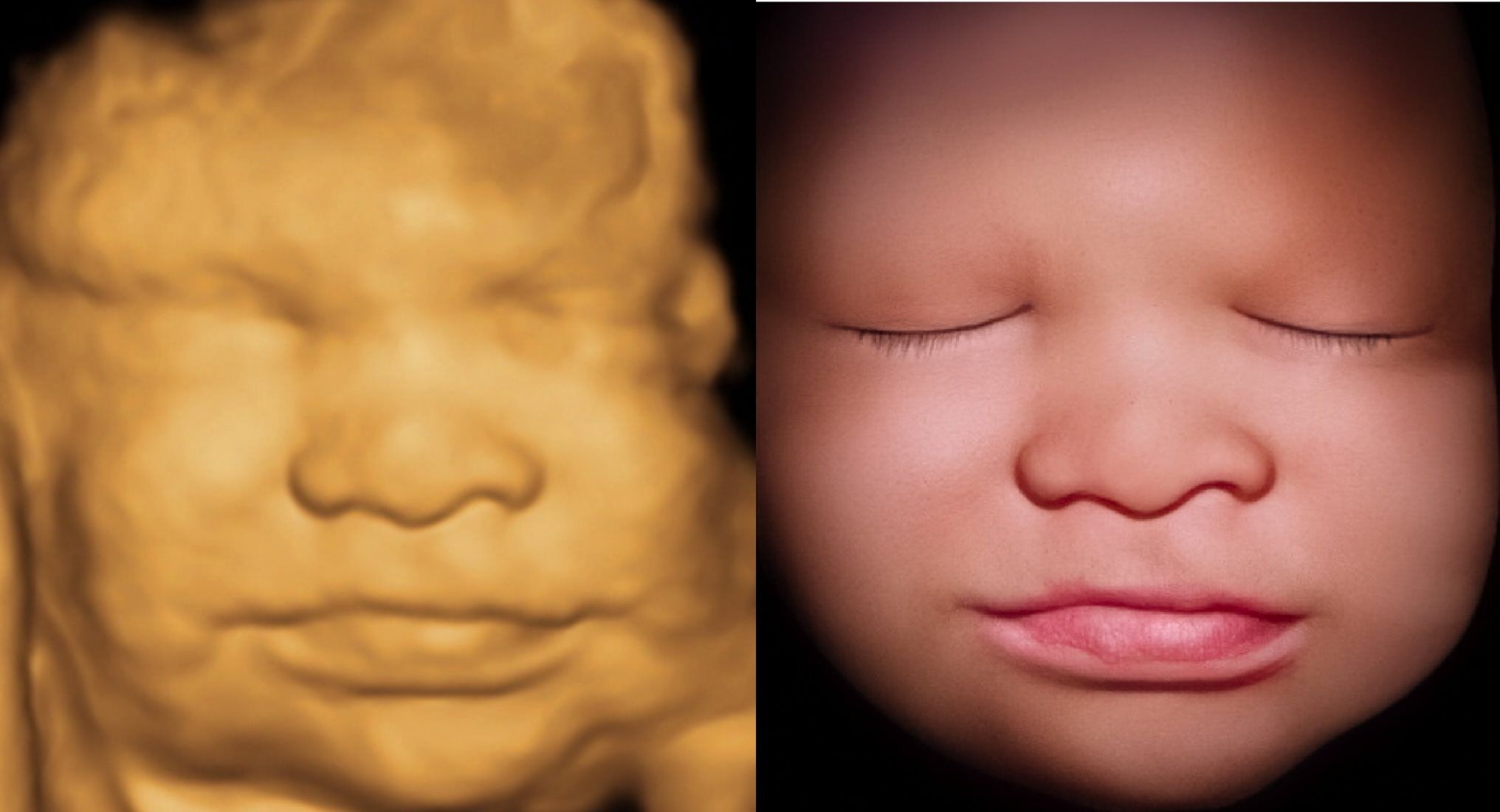 8K Image Enhancement - A Little Insight 3D/4D Ultrasound